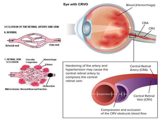 Retinal vein occlusion | PPTX | Eye and Vision Conditions | Diseases ...