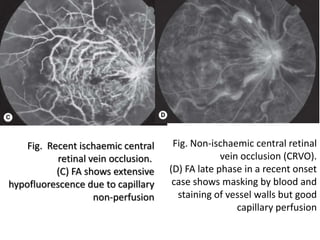 Retinal vein occlusion | PPTX