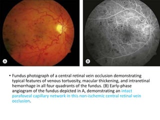 Retinal vein occlusion | PPTX