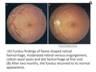 Retinal Flame Hemorrhage