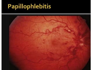 Papillophlebitis