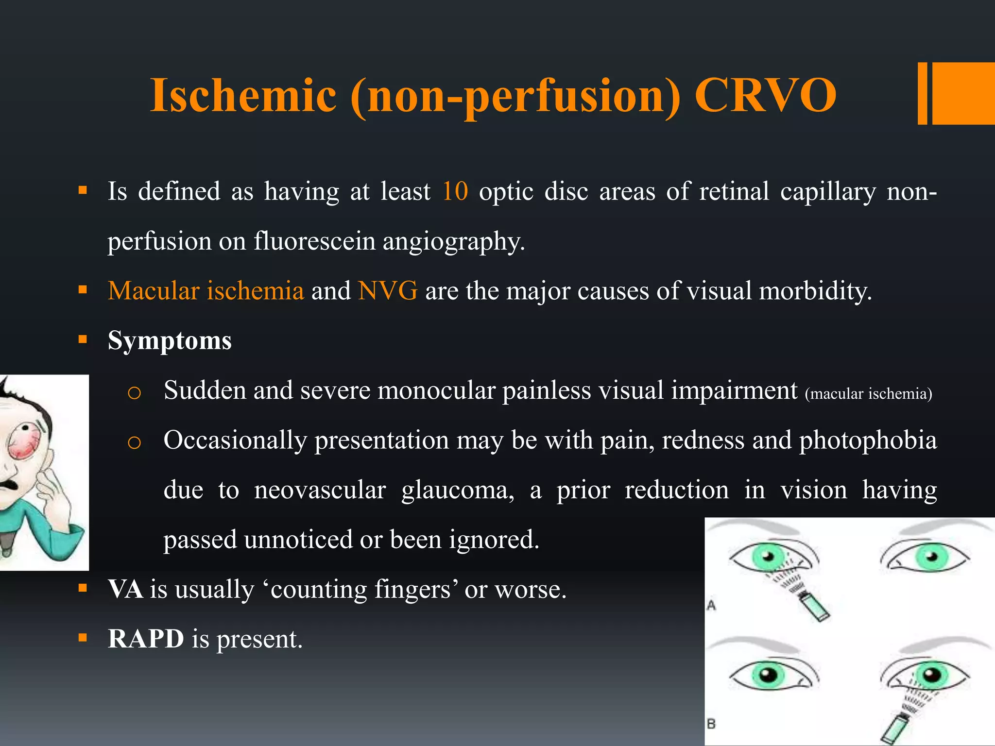 Retinal vein occlusion | PPTX