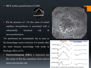 Retinal vein occlusion | PPTX
