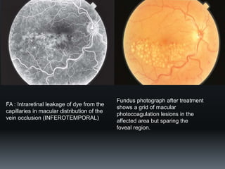 Retinal vein occlusion | PPTX