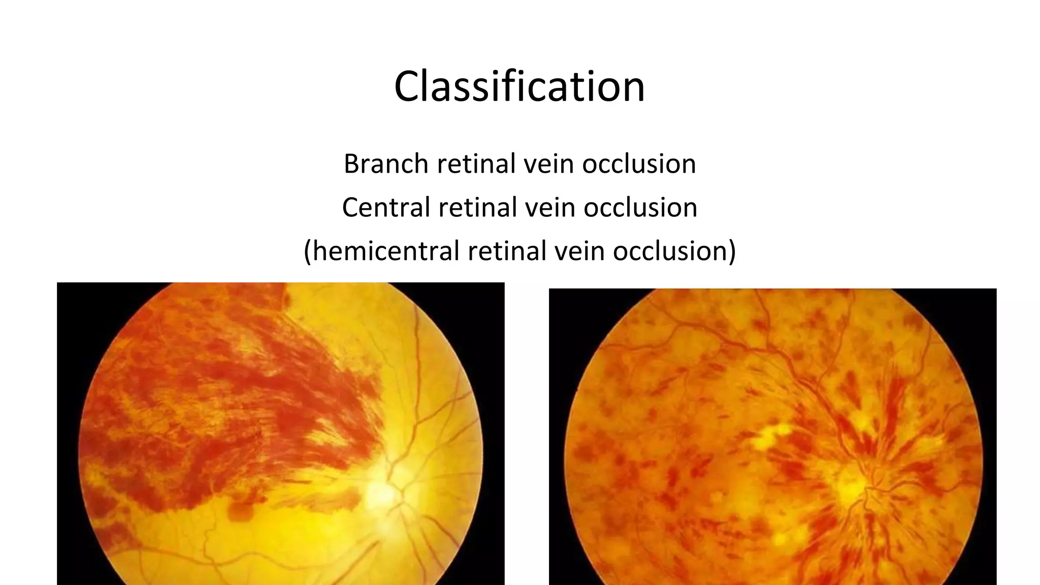 Retinal vein occlusion | PPTX
