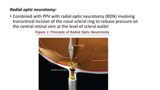 Retinal vein occlusion | PPTX