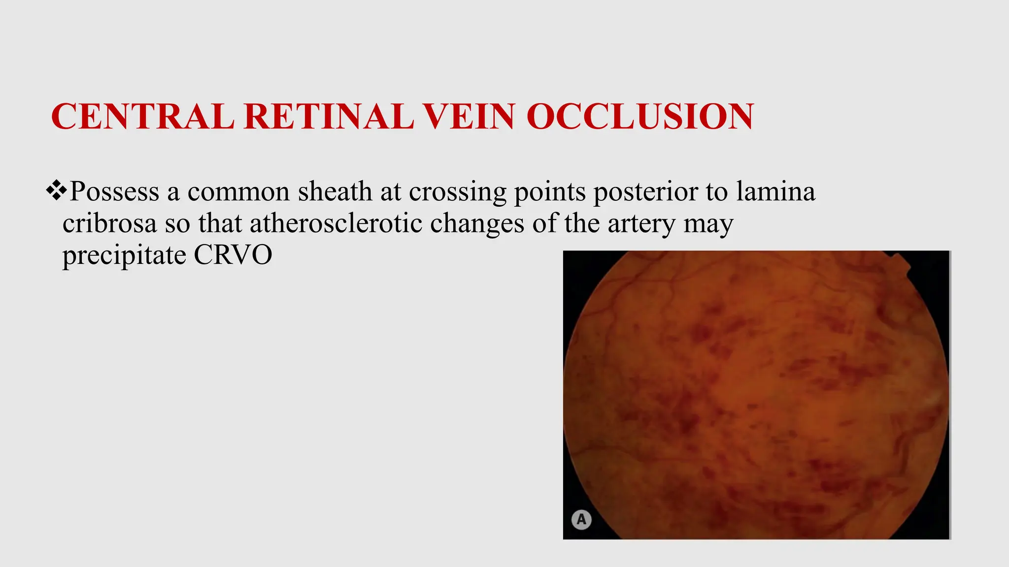 RETINAL VEIN OCCLUSION; CRVO & BRVO types, pathophysiology, diagnosis ...