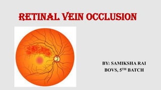 RETINAL VEIN OCCLUSION; CRVO & BRVO types, pathophysiology, diagnosis ...