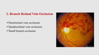 RETINAL VEIN OCCLUSION; CRVO & BRVO types, pathophysiology, diagnosis ...