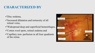 RETINAL VEIN OCCLUSION; CRVO & BRVO types, pathophysiology, diagnosis ...