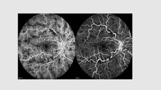 RETINAL VEIN OCCLUSION; CRVO & BRVO types, pathophysiology, diagnosis ...