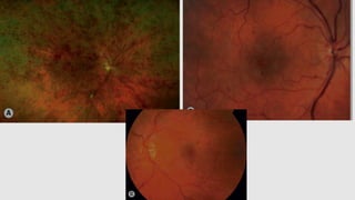RETINAL VEIN OCCLUSION; CRVO & BRVO types, pathophysiology, diagnosis ...