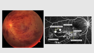 RETINAL VEIN OCCLUSION; CRVO & BRVO types, pathophysiology, diagnosis ...