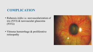RETINAL VEIN OCCLUSION; CRVO & BRVO types, pathophysiology, diagnosis ...