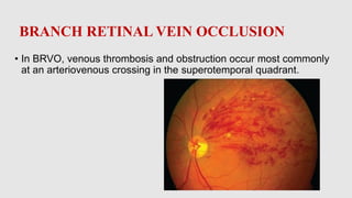 RETINAL VEIN OCCLUSION; CRVO & BRVO types, pathophysiology, diagnosis ...
