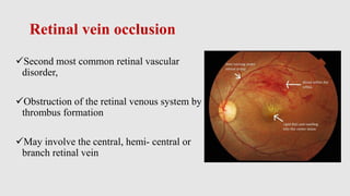 RETINAL VEIN OCCLUSION; CRVO & BRVO types, pathophysiology, diagnosis ...