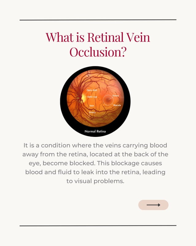 Retinal Vein Occlusion (RVO) – What You Need to Know! | PDF