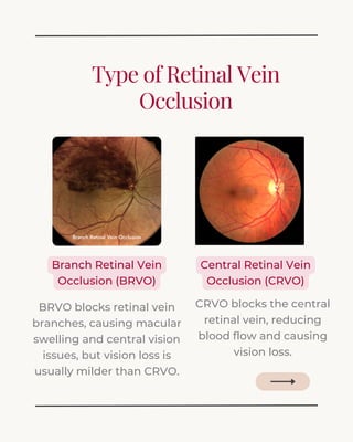 Retinal Vein Occlusion (RVO) – What You Need to Know! | PDF