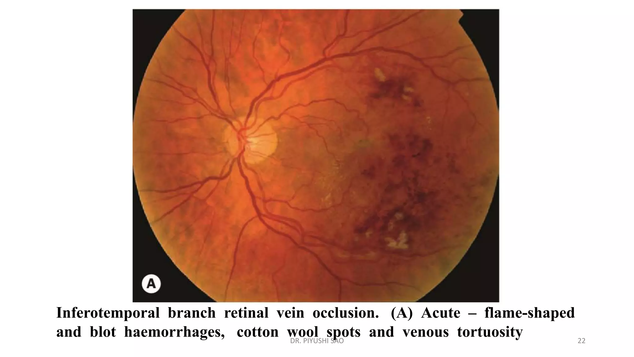 Retinal vein occlusions | PPTX