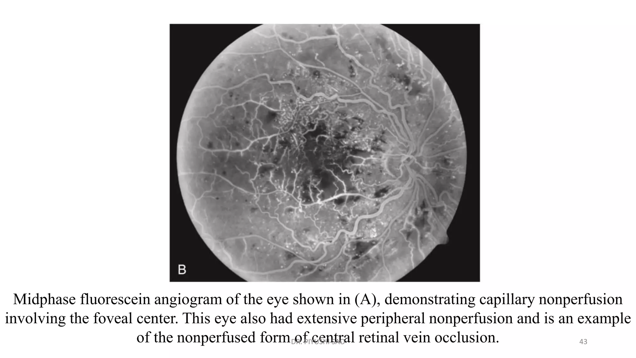 Retinal vein occlusions | PPTX