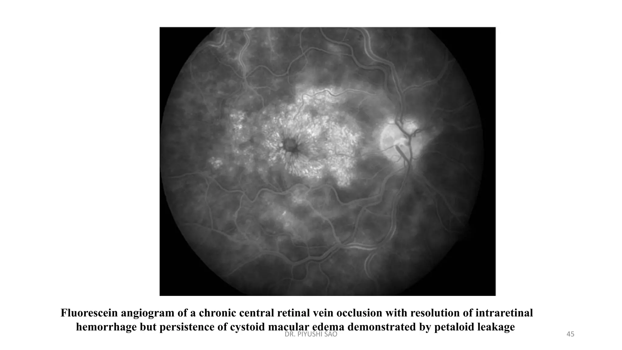 Retinal vein occlusions | PPTX