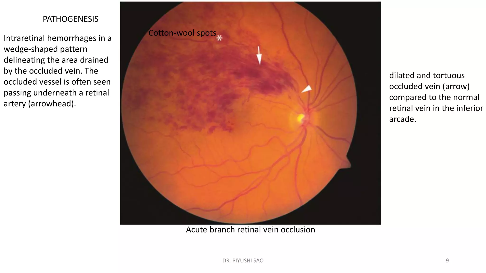 Retinal vein occlusions | PPTX