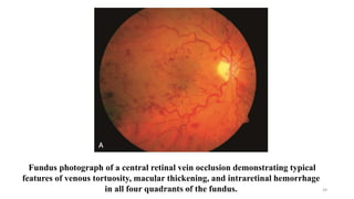 Retinal vein occlusions | PPTX