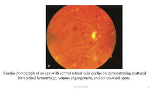 Retinal vein occlusions | PPTX