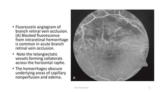 Retinal vein occlusions | PPTX