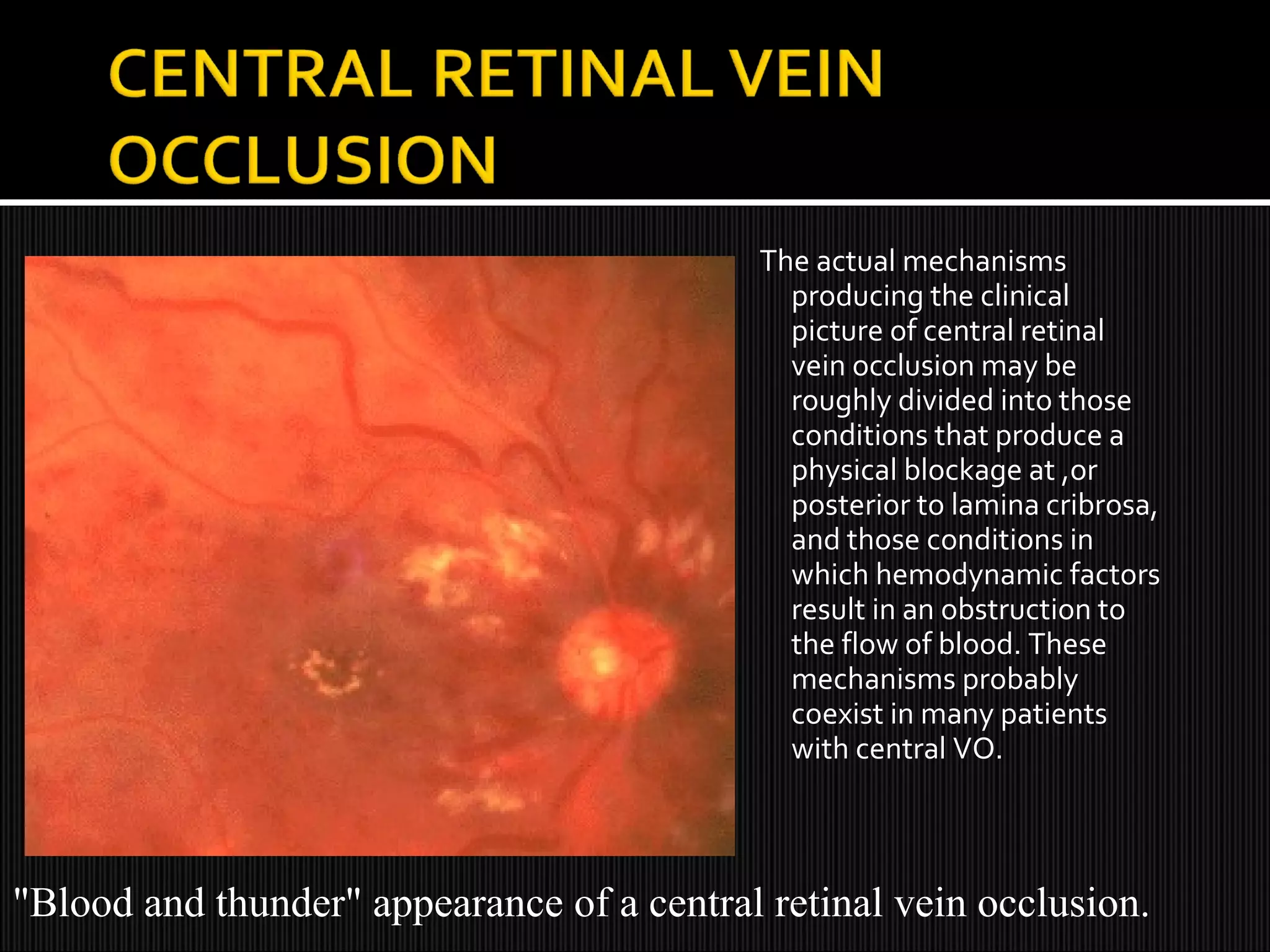 Retinal vein occlusions | PPT