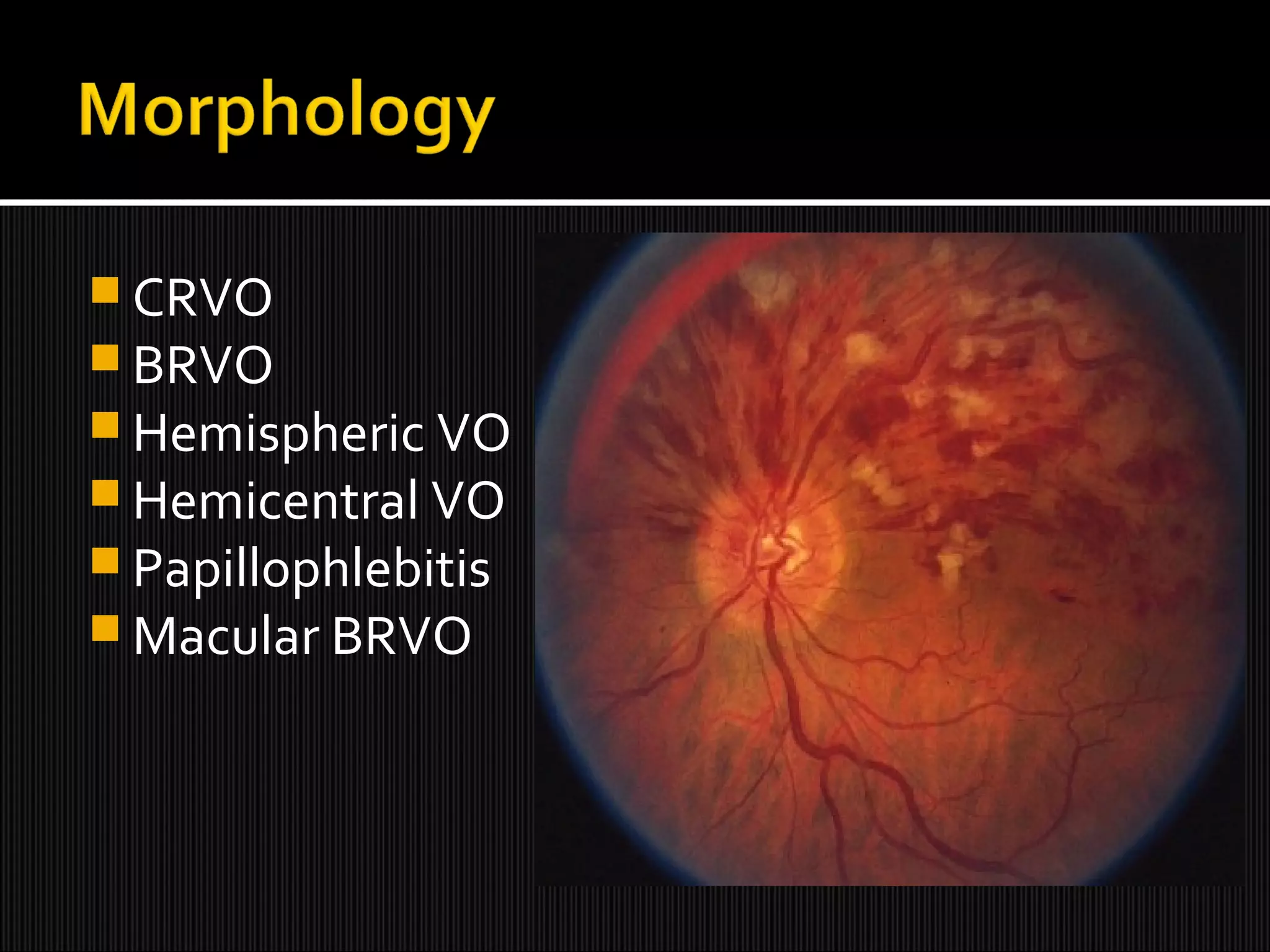 Retinal vein occlusions | PPT