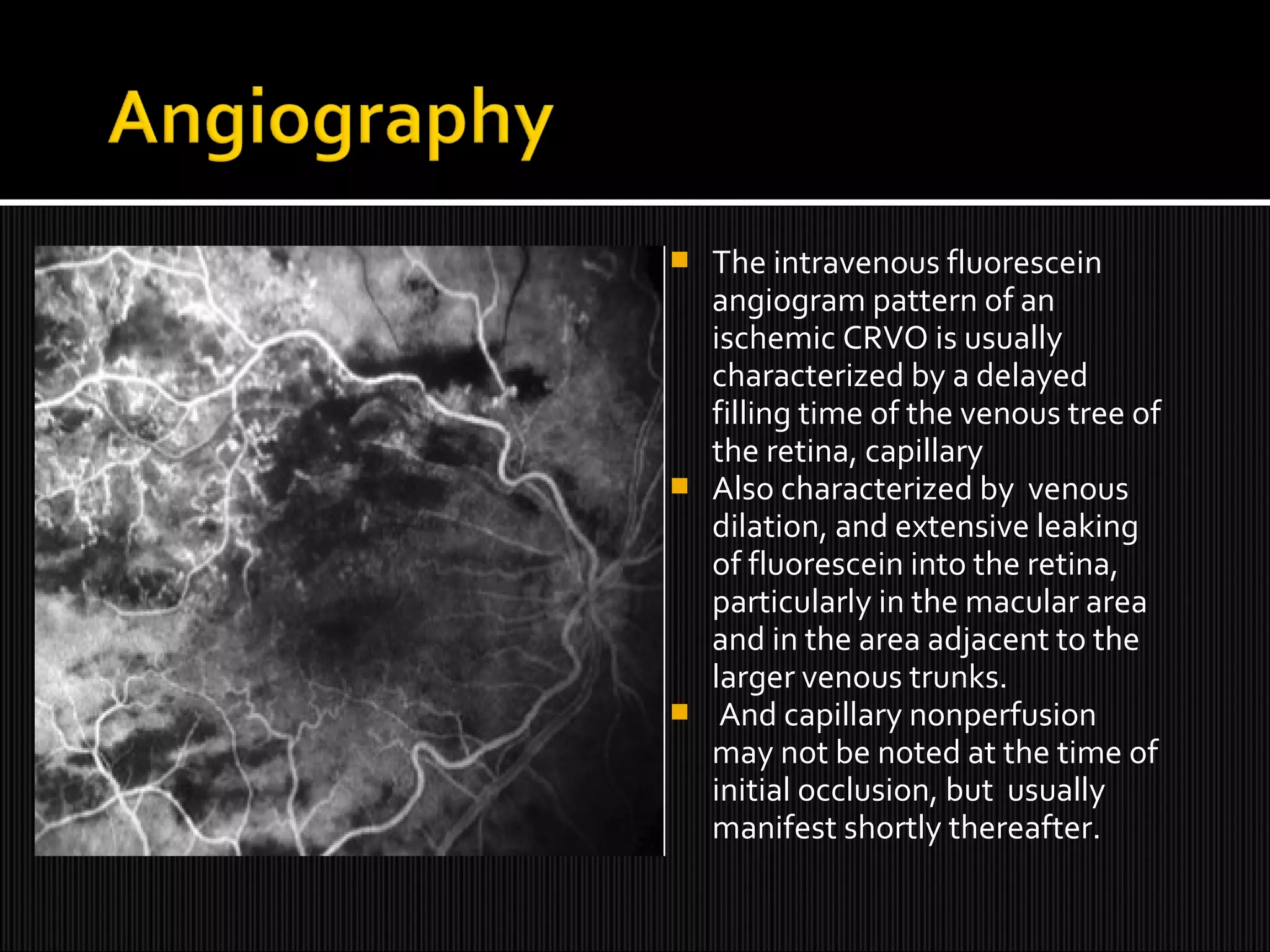 Retinal vein occlusions | PPT