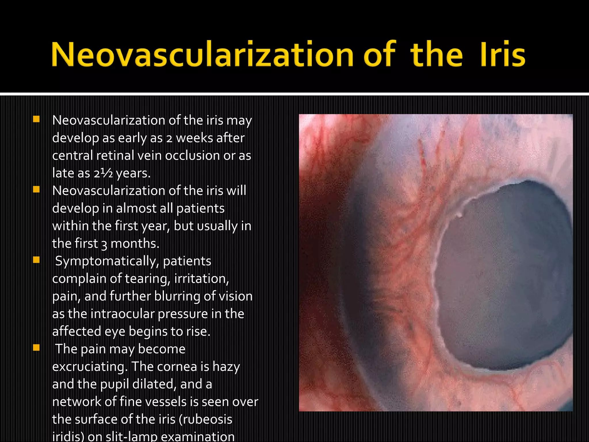 Retinal vein occlusions | PPT