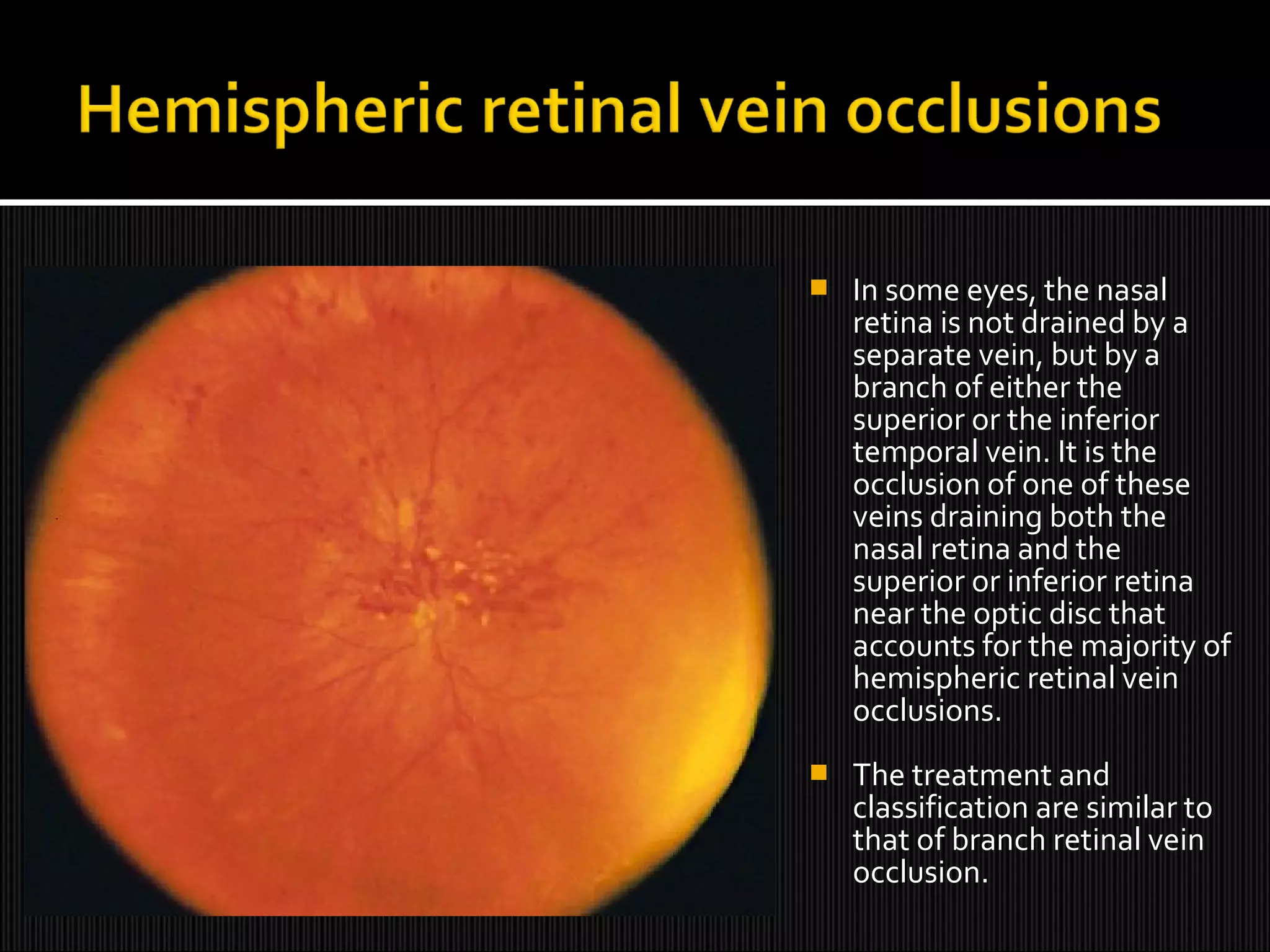 Retinal vein occlusions | PPT