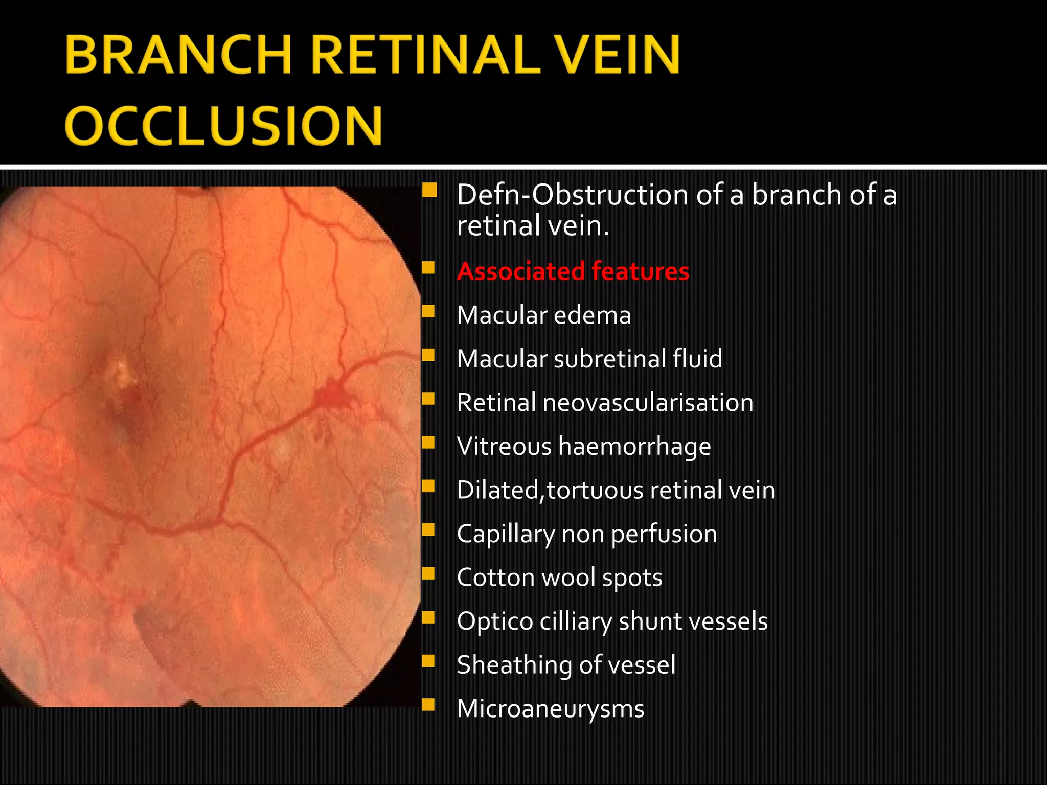 Retinal vein occlusions | PPT