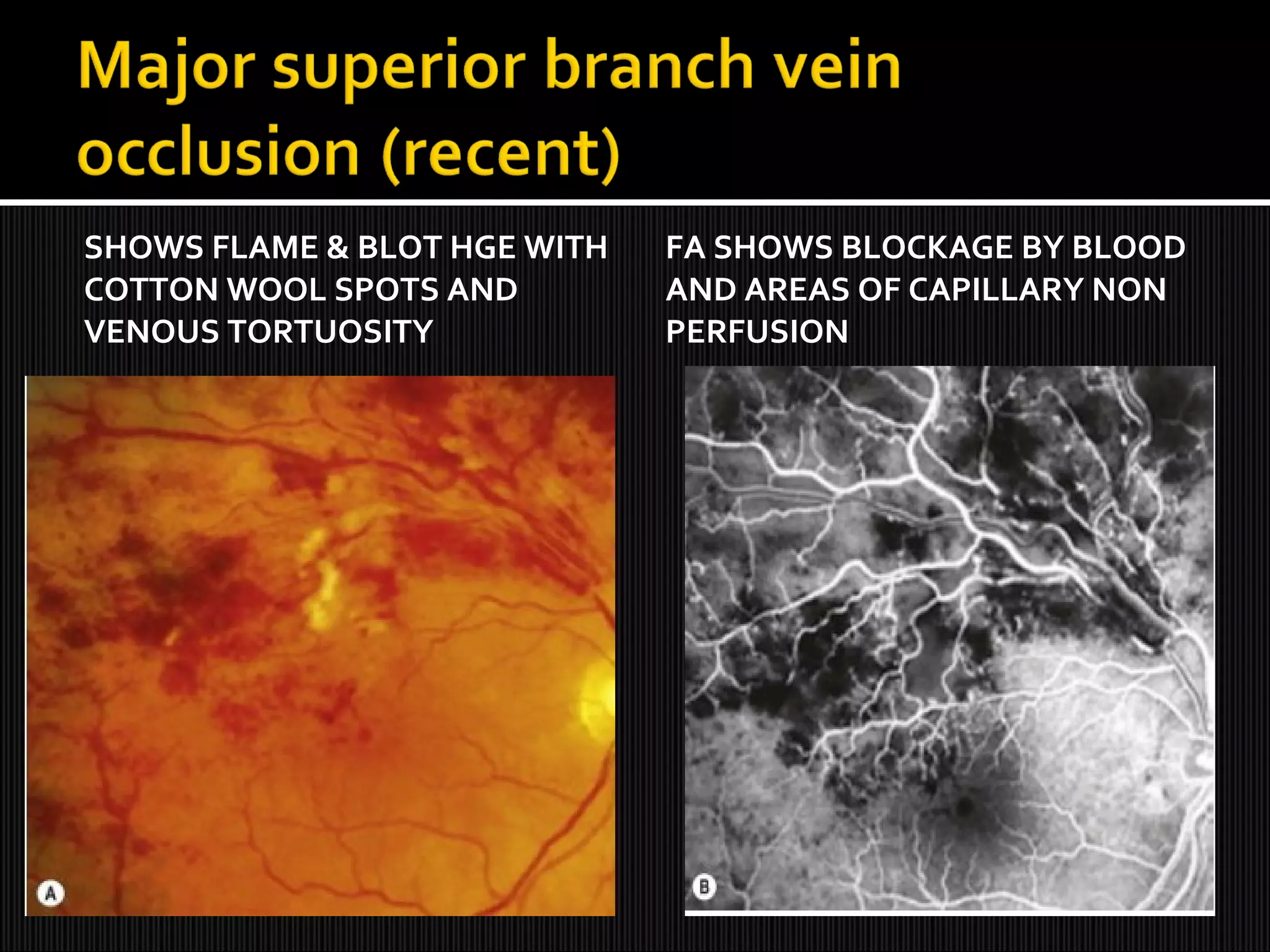 Retinal vein occlusions | PPT