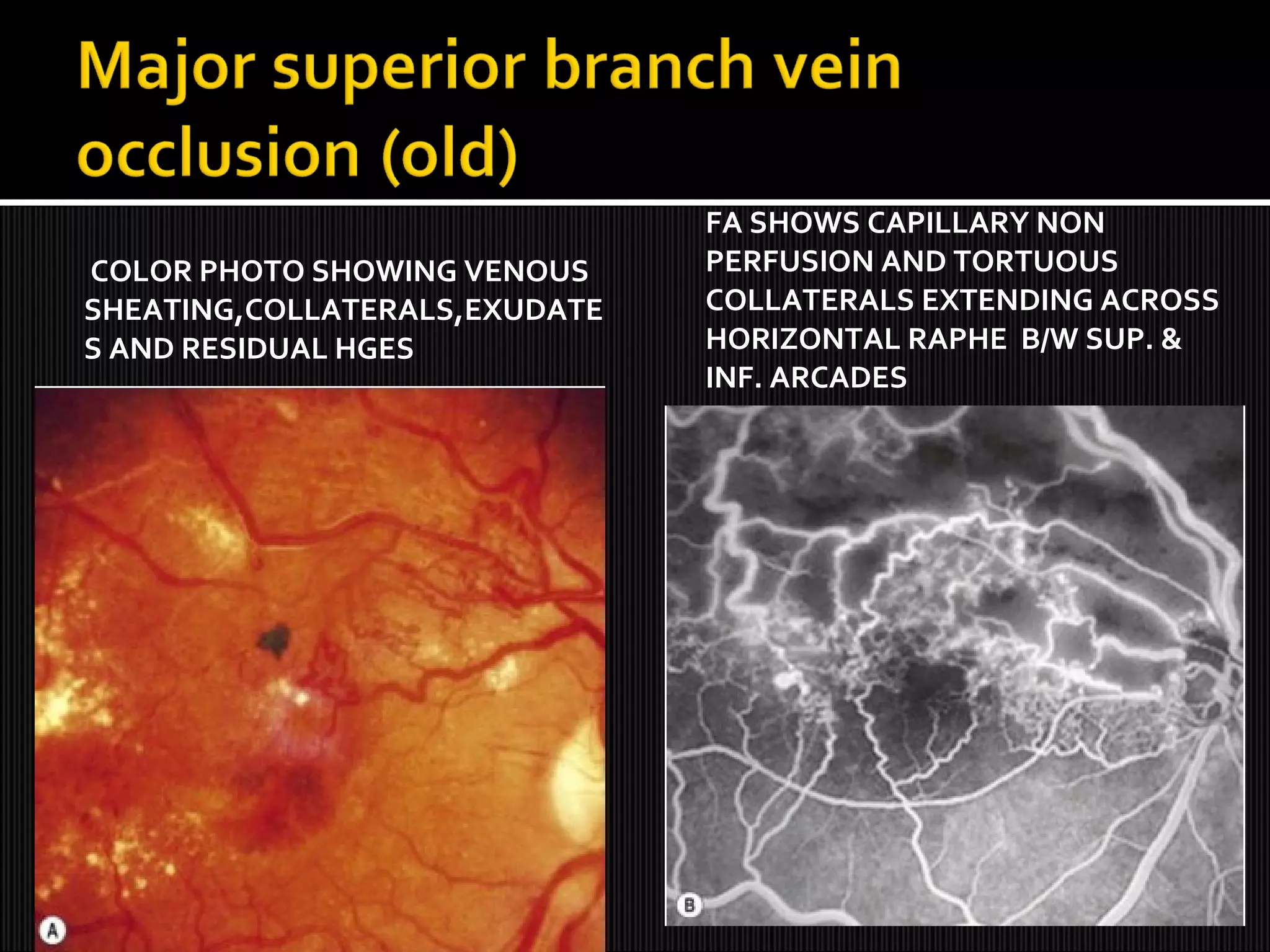 Retinal vein occlusions | PPT