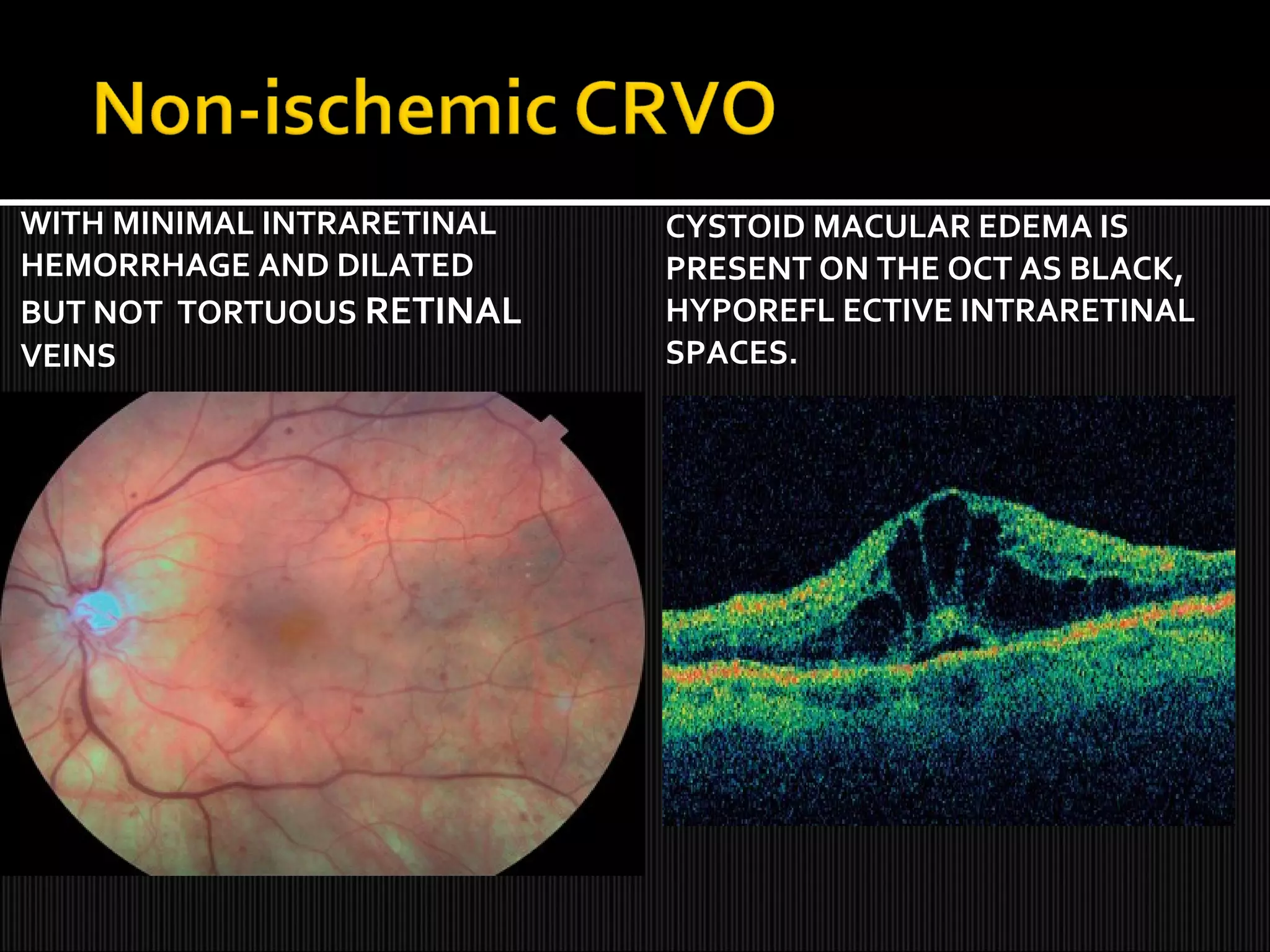 Retinal vein occlusions | PPT