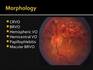 Retinal vein occlusions | PPT