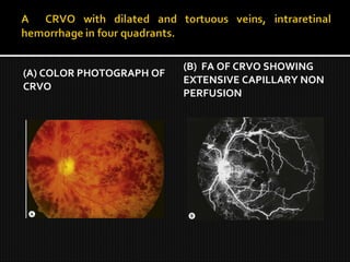 Retinal vein occlusions | PPT