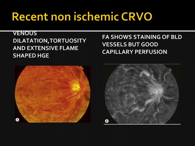 Retinal vein occlusions | PPT