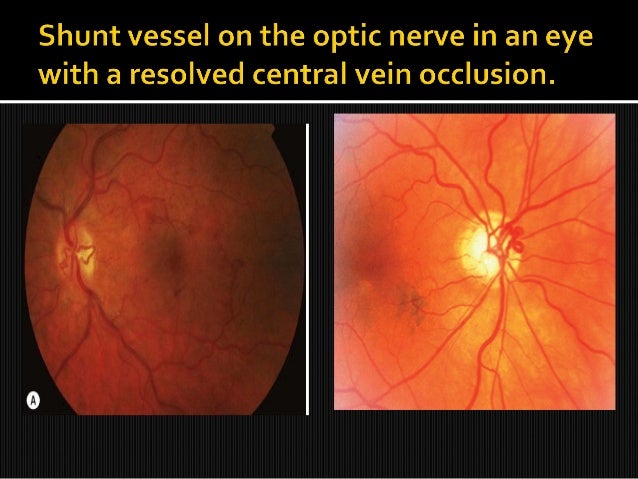 Retinal vein occlusions