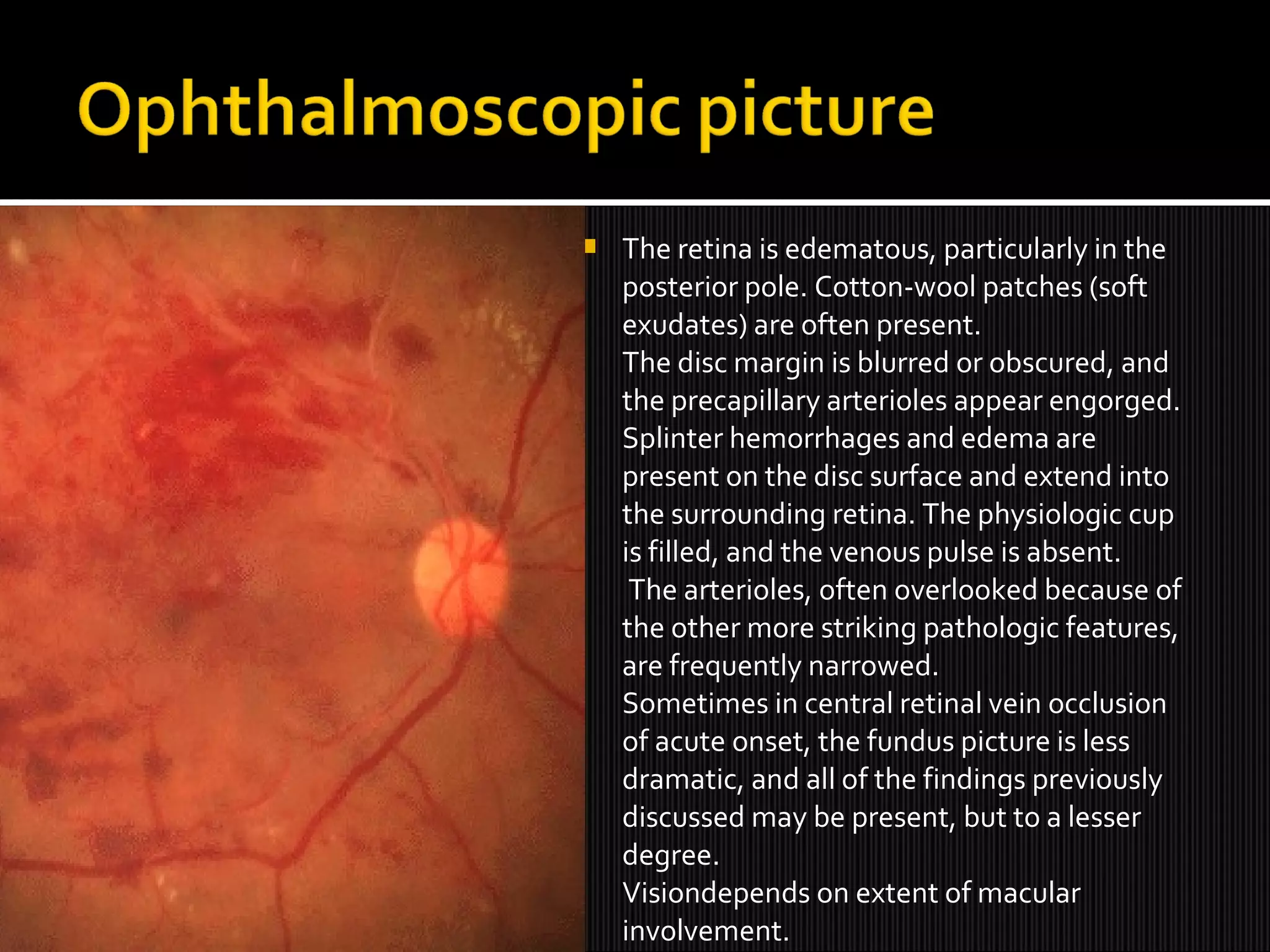 Retinal vein occlusions | PPT