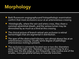 Retinal vein occlusions | PPT