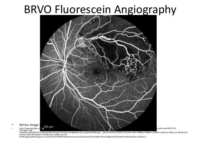 Retinal vein occlusions 3