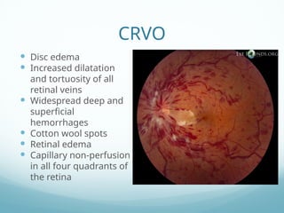 Retinal Vein Occlusion studies Riyad Banayot.pptx