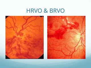 Retinal Vein Occlusion studies Riyad Banayot.pptx