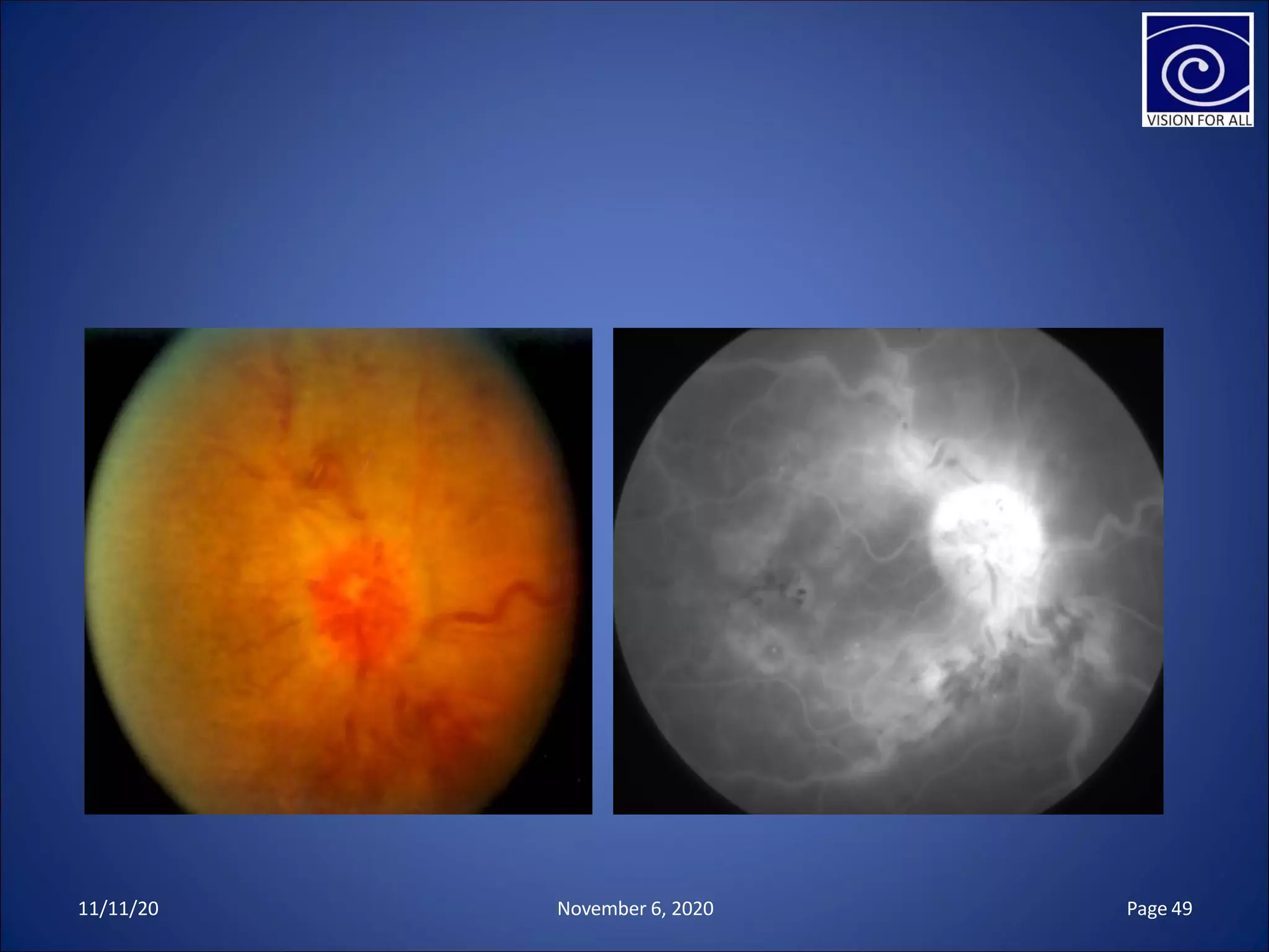 Retinal vein occulision | PPT