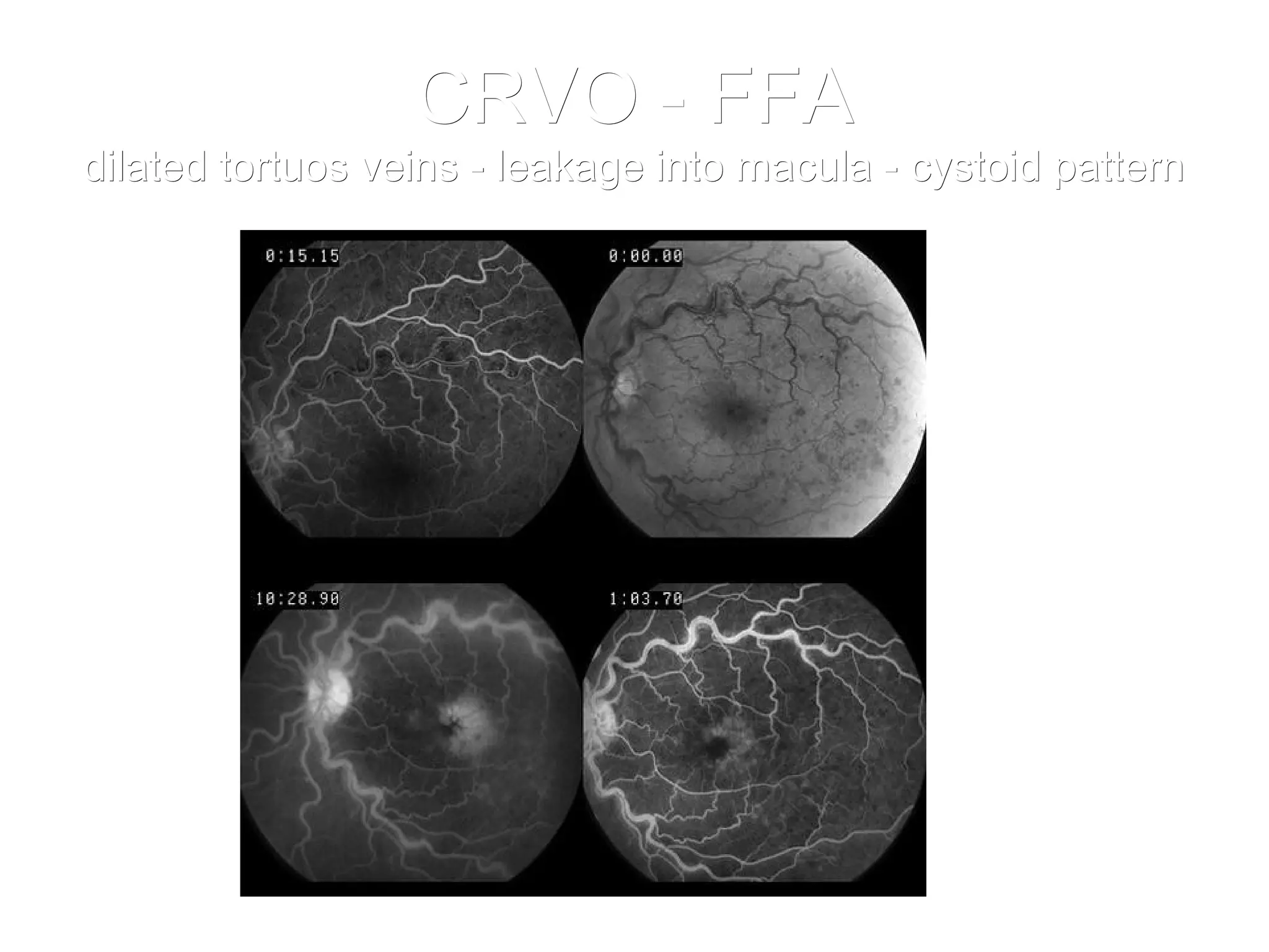 Retinal venous occlusive disease | PPT