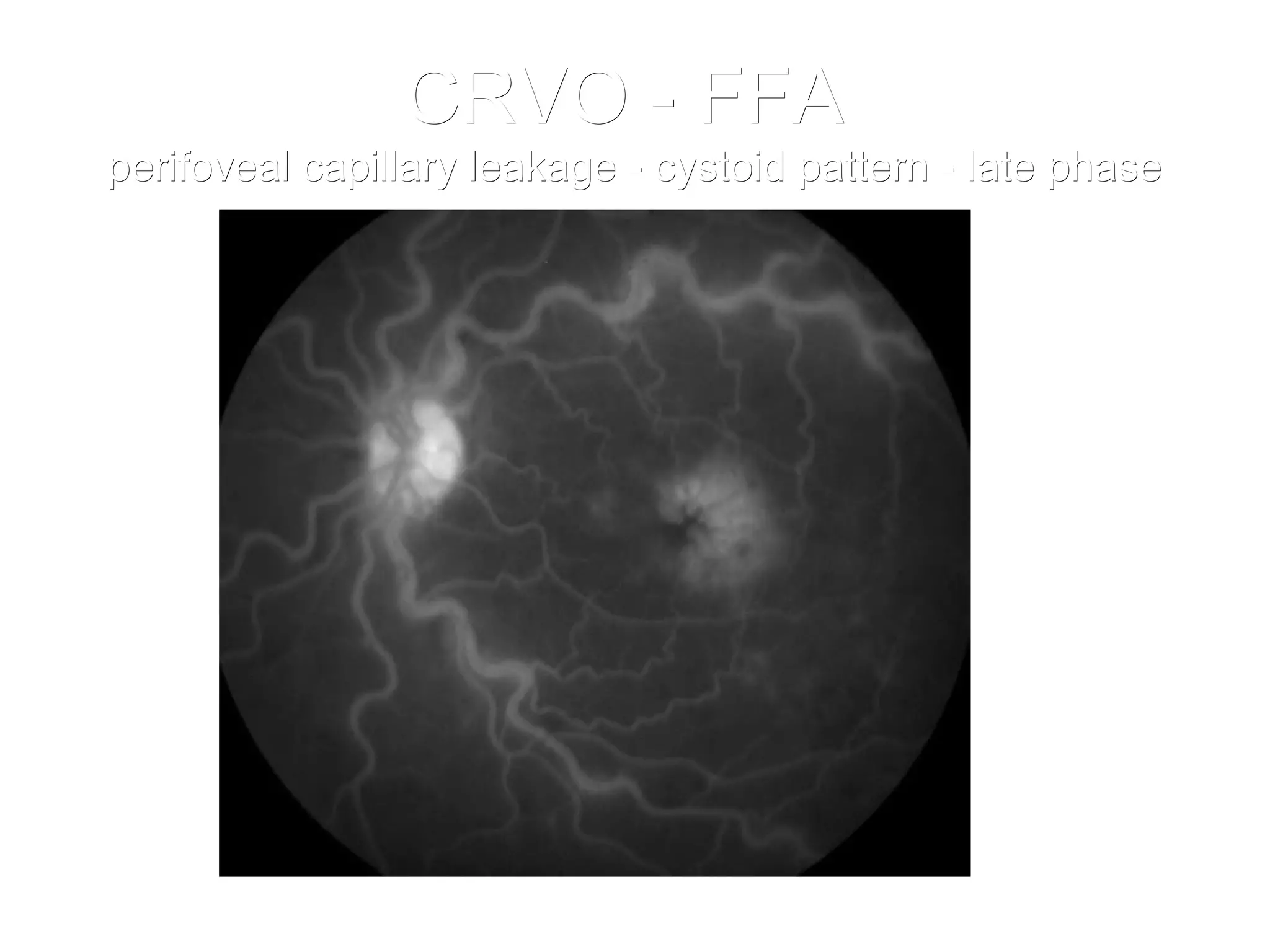Retinal venous occlusive disease | PPT